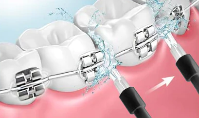 Article Water flossing vs string flossing – DentaLocator